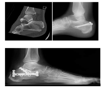 Calcaneum Fracture - Olwen Hospital