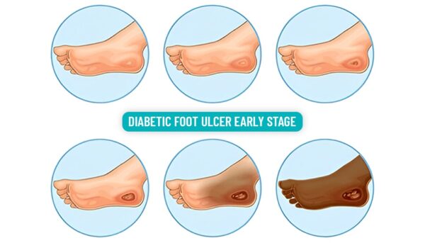 Diabetic Foot Ulcer Early Stage - Olwen Hospital